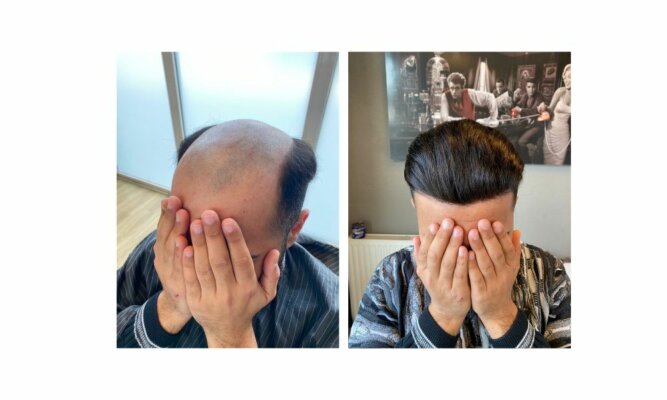 Premium Men's Toupee & Custom Wigs - HairNotion