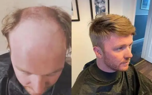 Why Do Men Prefer Toupees for Hair Loss? These Benefits Might Surprise You!