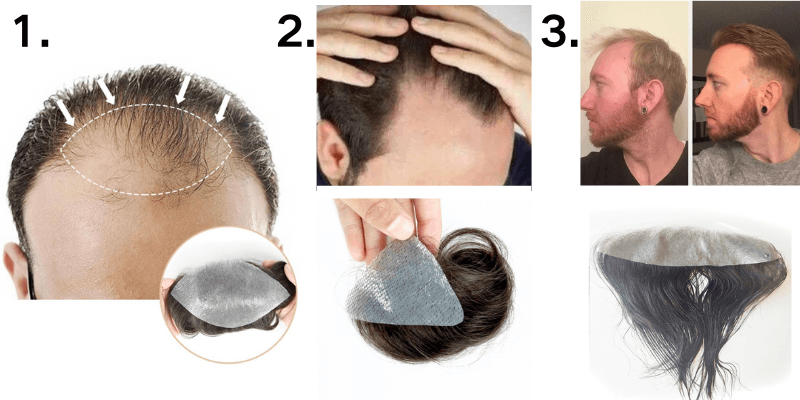 Temple Hair Patch: The Ultimate Solution for Thinning Temples